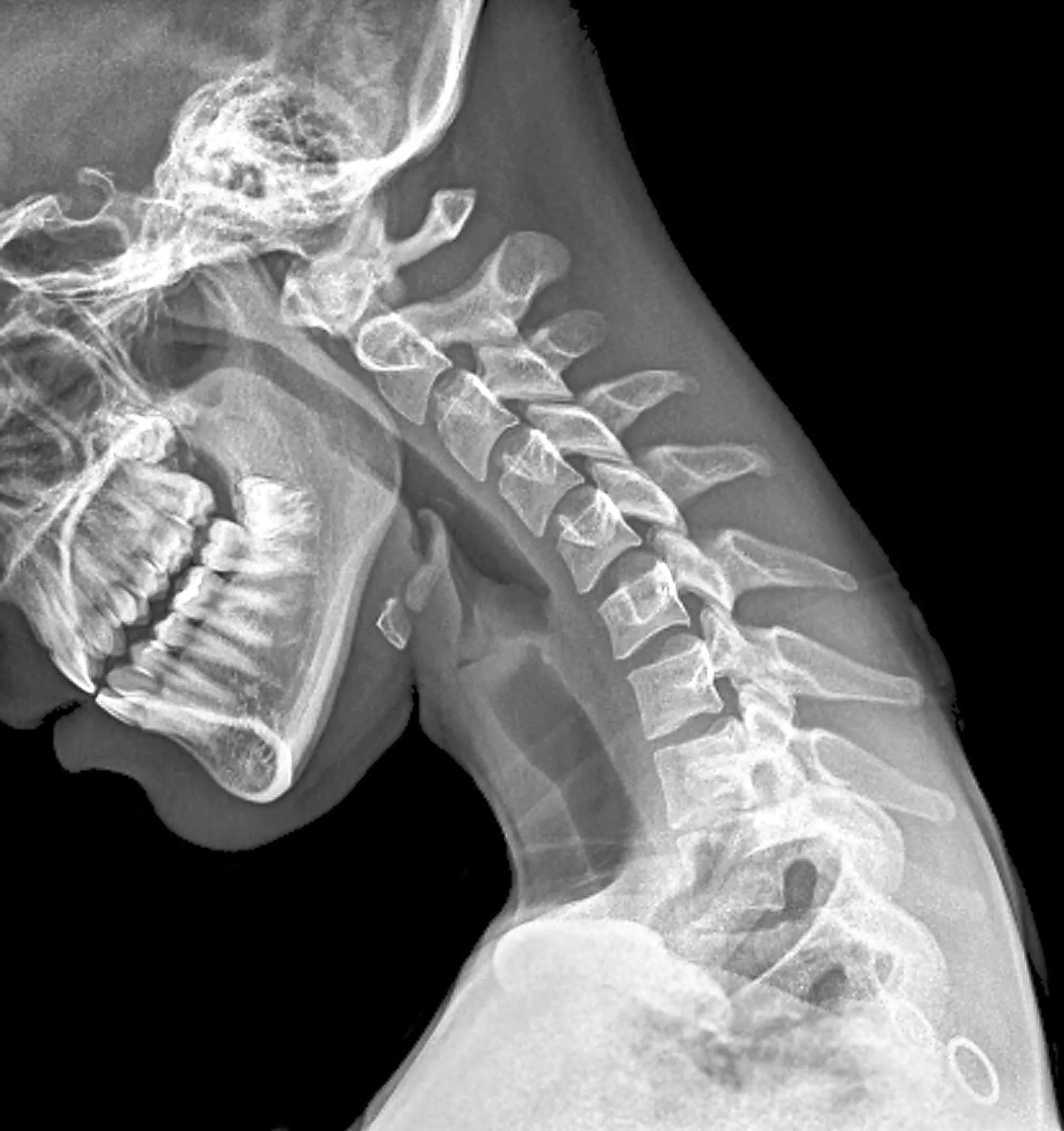 How Is C-Spine X-Ray Done?